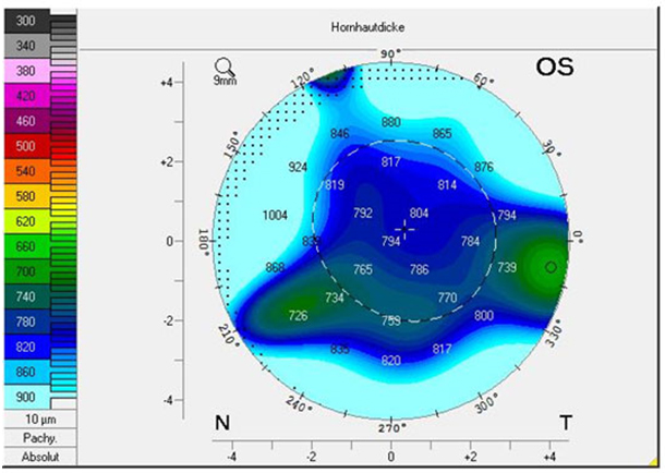 Descemet membrane endothelial keratoplasty after sequential radial ...