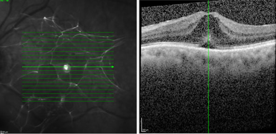 Descemet membrane endothelial keratoplasty after sequential radial ...