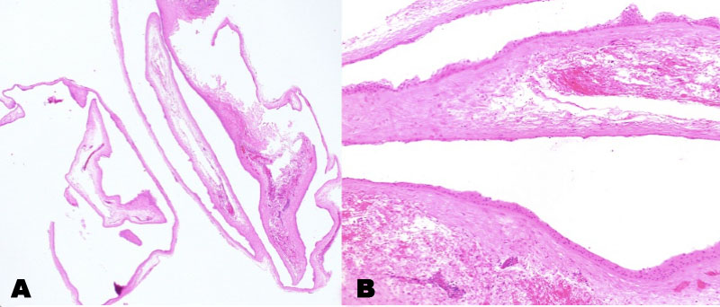 Large conjunctival epithelial inclusion cyst following scleral tunnel ...