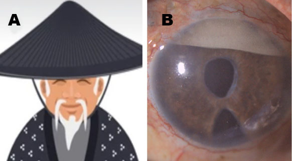 The ancient gaze: Hyperoleon in the eye, a resemblance to traditional ...